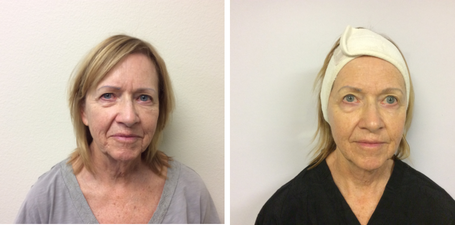 NeurotriS Microcurrent - non-invasive solution for facial & body sculpting