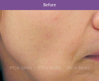 PCA Skin - Hyperpigmentation, Acne, Rosacea, Aging, Psoriasis